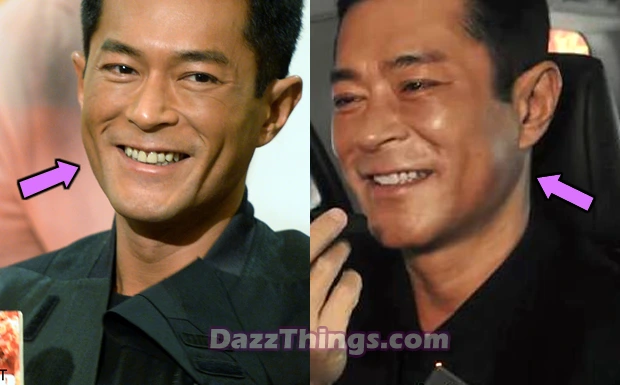 Plastic Surgery Alert! Hong Kong actor Louis Koo had work done?