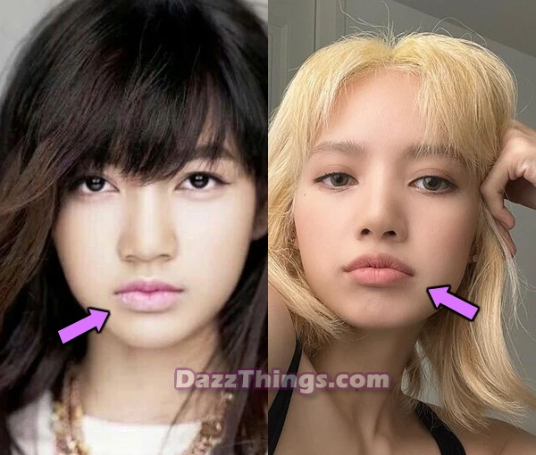 Lisa (Blackpink) Plastic Surgery Comparison Photos