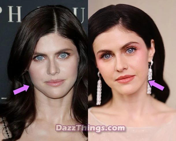 Alexandra Daddario Plastic Surgery Comparison Photos