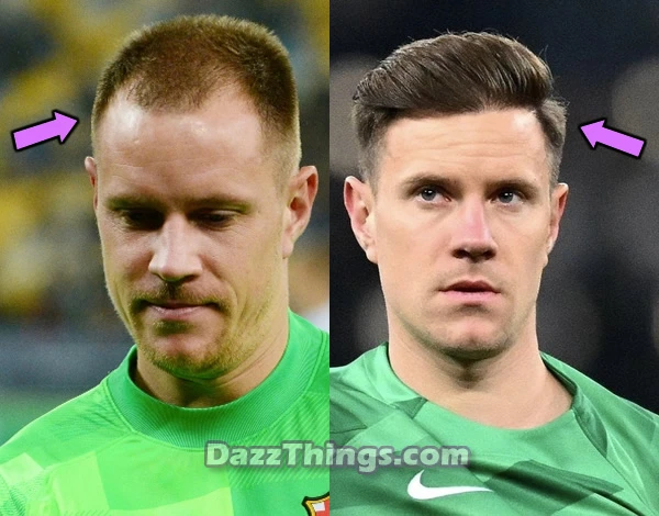 Ter Stegen's Hair Restoration Journey